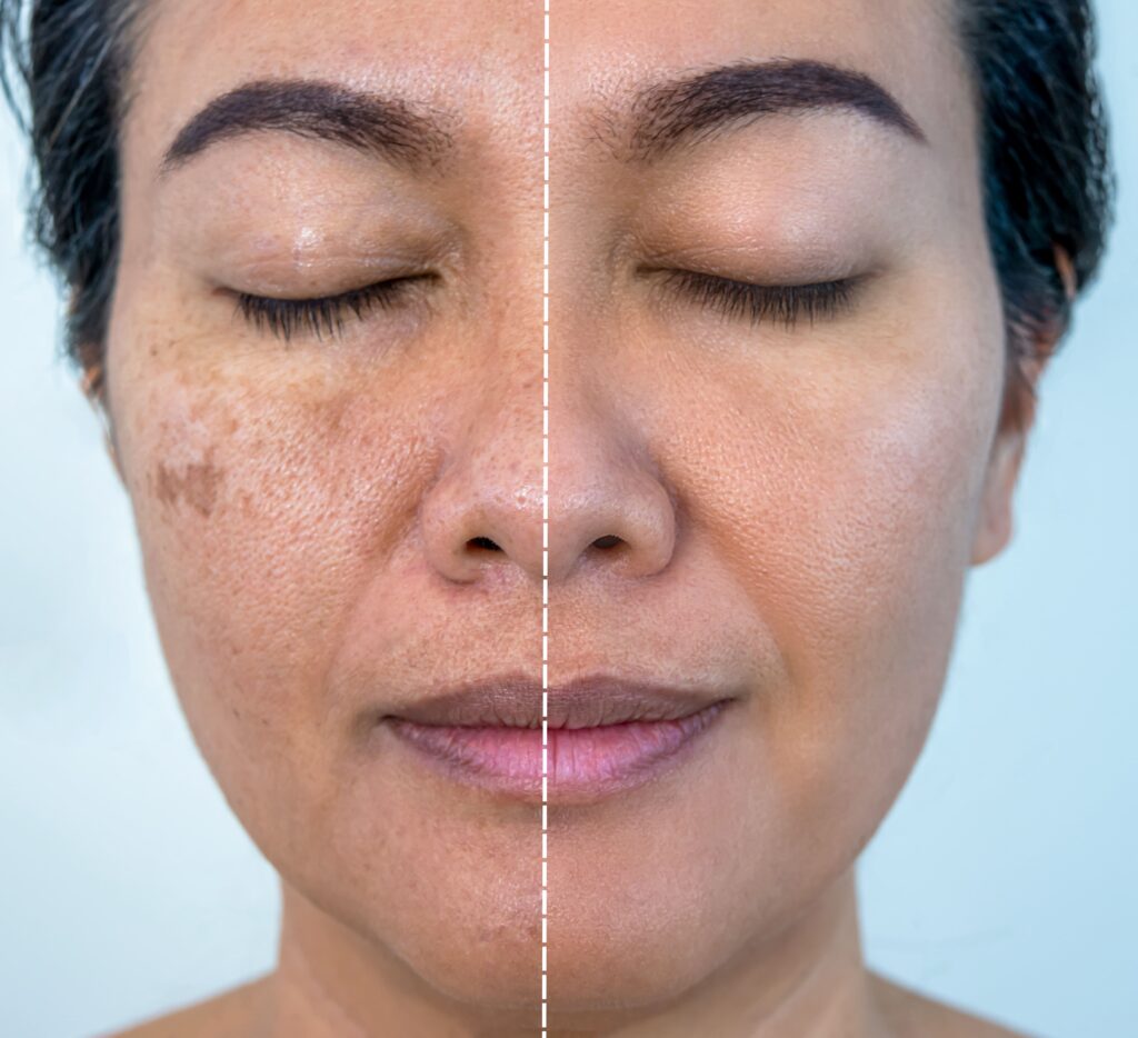 Chemical Peels - Paragon Skin & Surgery